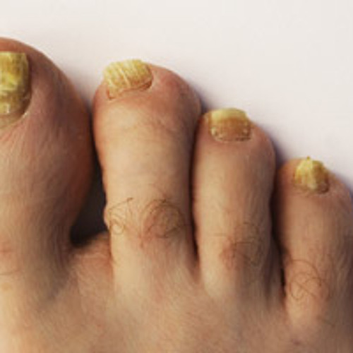 Crusty Toenails