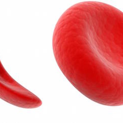 Stream Sickle Cell Acute Chest Syndrome 2015 by EM Cases Podcast ...