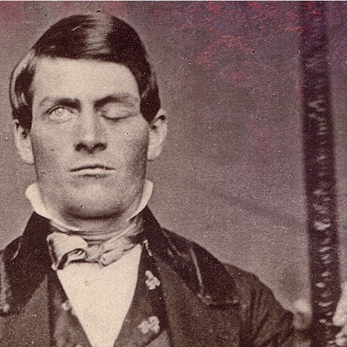 Stream Phineas Gage (caught a rod through the brain) by That Dan ...