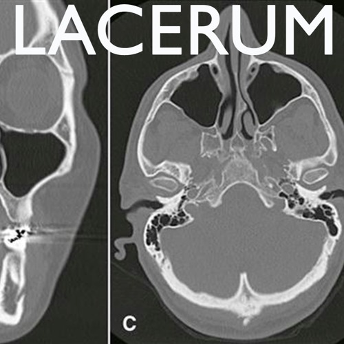 Foramen Lacerum