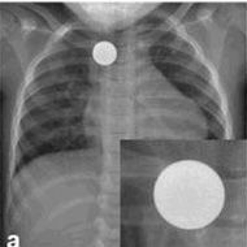 Stream episode Button Battery Ingestion by BIR podcast | Listen online ...