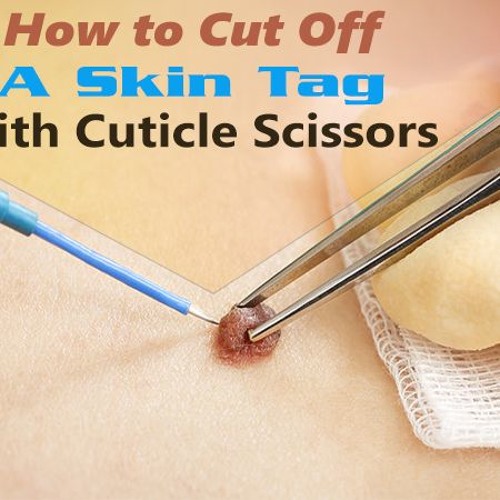 Stream Removing Skin Tags How To Cut Off A Skin Tag With Cuticle Scissors And More By Eric 