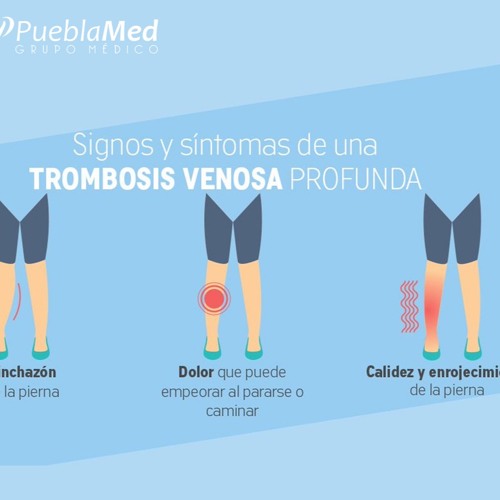 Stream Trombosis Venosa Profunda by PueblaMed | Listen online for free ...
