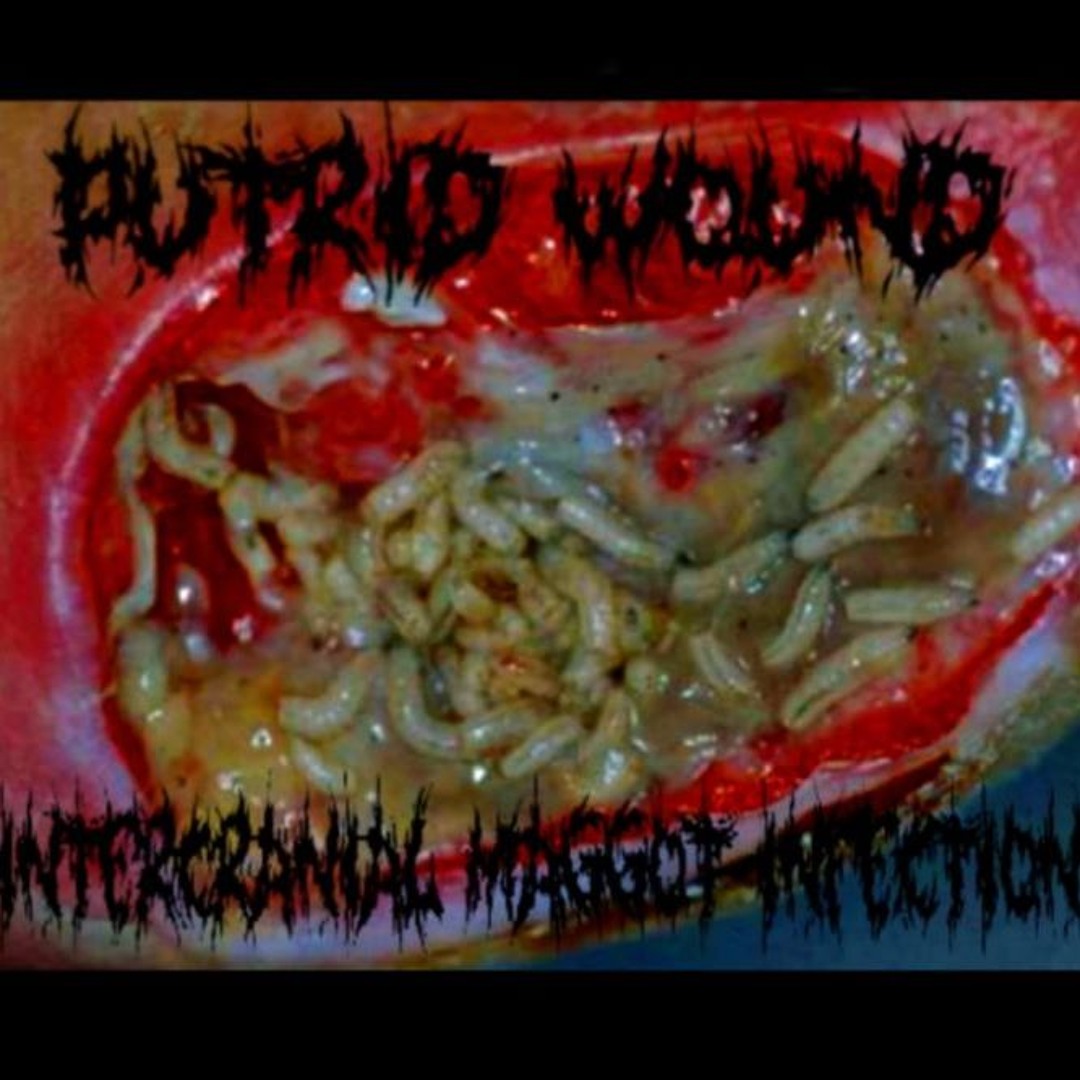 Stream Putrid Wound | Listen to Intercranial Maggot Infection playlist ...