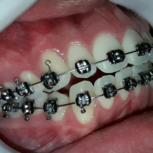 Stream Vertical changes following orthodontic extraction treatment in ...