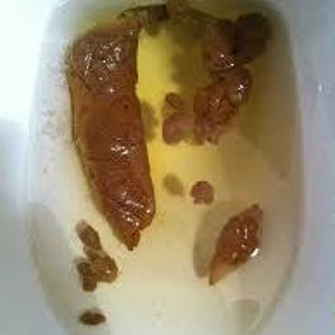 Stream rash, lil caca, yung nostril diarrhea by yung caca | Listen ...