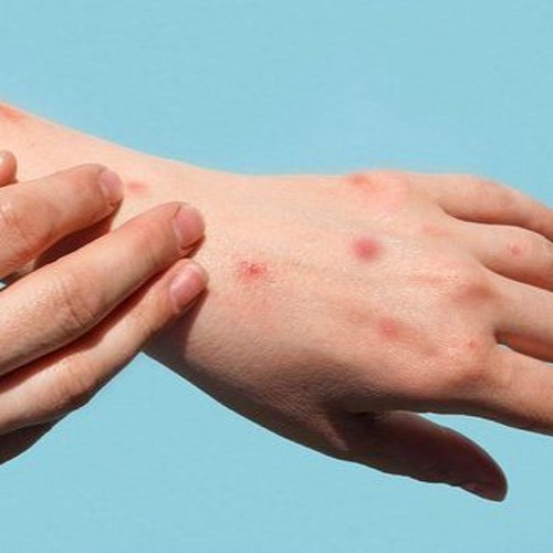 Stream Mpox Outbreak Public Concerns Following Whos Global Health