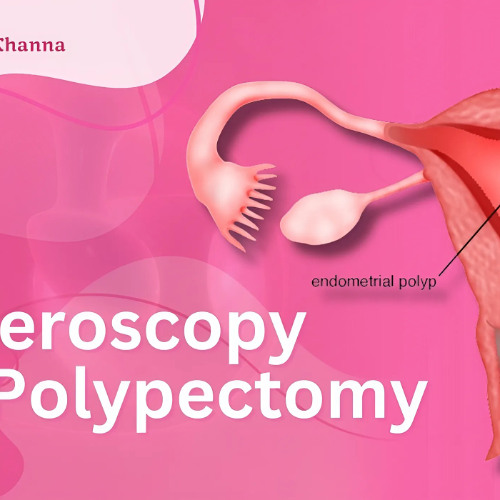 Stream Understanding the Procedure of Hysteroscopic Polypectomy by ...