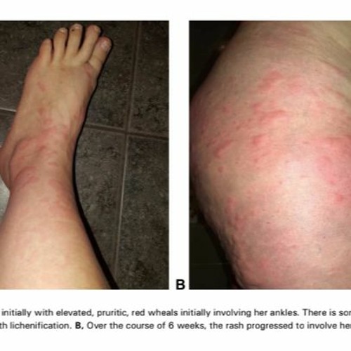 Stream episode 07E04 Type 2 inflammation Chronic Spontaneous Urticaria ...