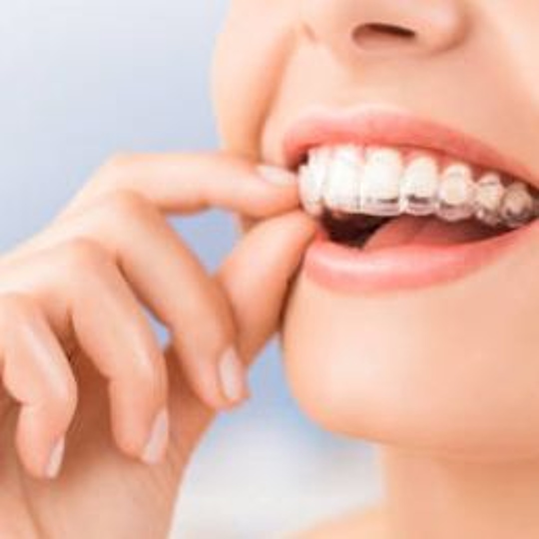 Stream Why Is Invisalign Better For Oral Hygiene? by Invisible Braces ...