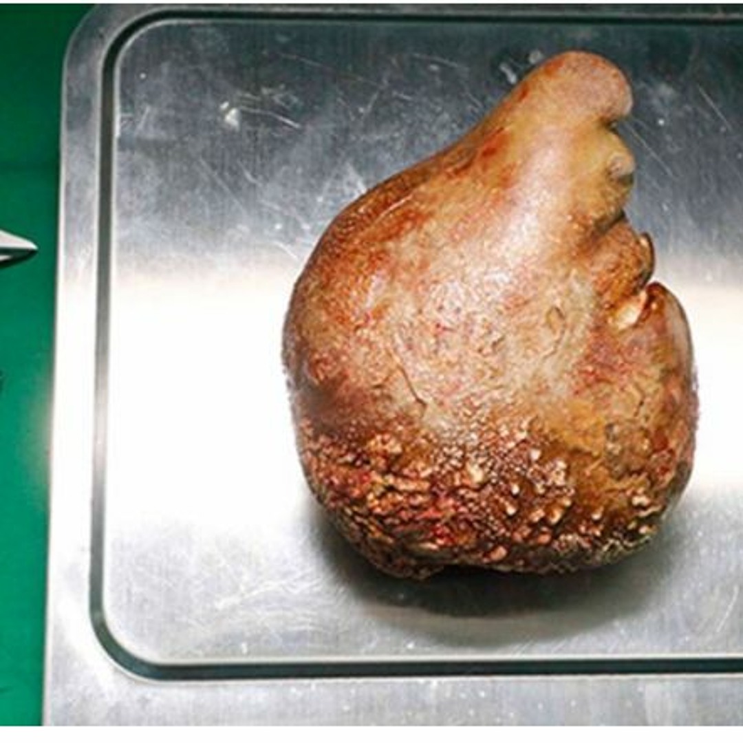 Stream Fake fact check: World’s largest kidney stone by Radio Islam ...