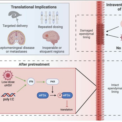 Stream episode Intraventricular Immunovirotherapy; A Translational Step ...