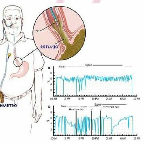 Stream episode MONITORIZACIÓN DEL pH ESOFÁGICO by OSIRIS-MUÑOZ podcast ...