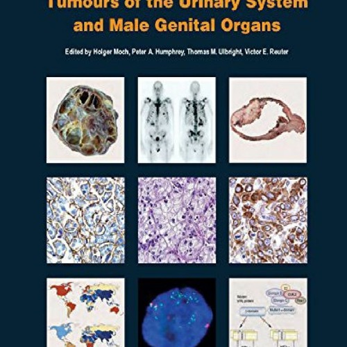 Stream episode [READ PDF] WHO Classification of Tumours of the Urinary ...