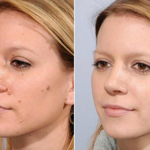 Stream Tru Skin Tag Remover Deminish Skin Scab & Moles Quickly *Top ...