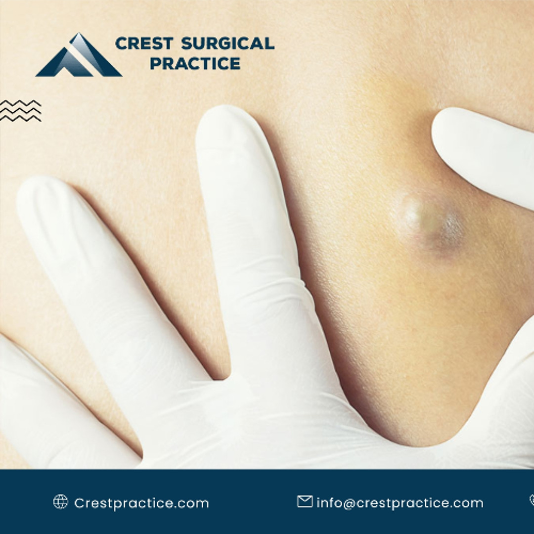 Stream Skin Cyst Removal_ When Surgery is Necessary by Crest Surgical ...