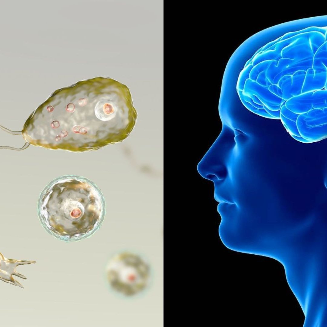 Stream The First Case Of A Deadly Brain - Eating Amoeba Infection Has ...