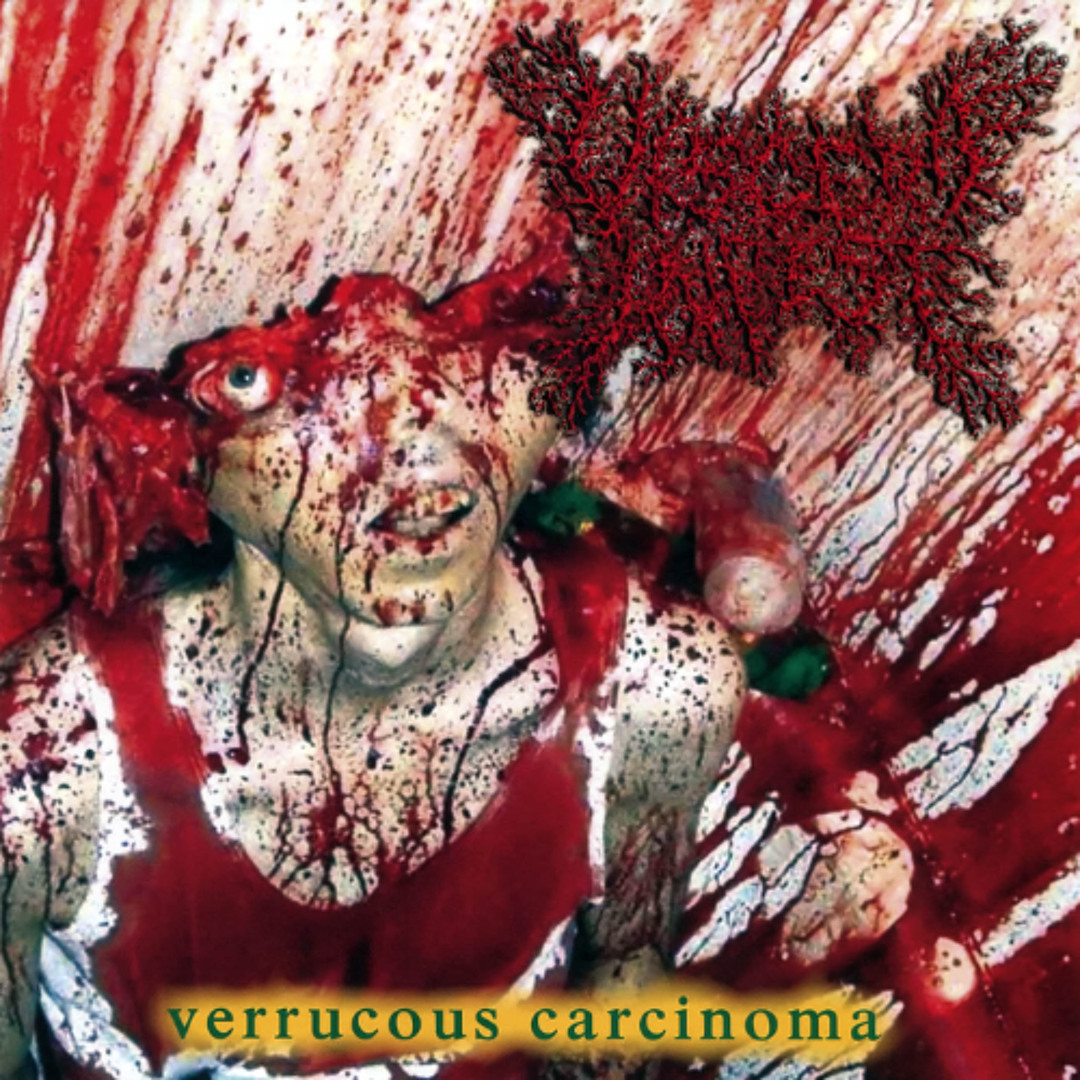 Stream ‎ | Listen to Viscera Infest - Verrucous Carcinoma (2015 ...