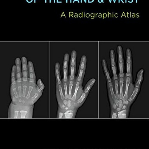 Stream episode ( PDF BOOK⭐) Skeletal Development of the Hand and Wrist ...