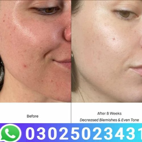 Stream Original Tretinoin Cream In Pakistan 03025023431 Natural By Kaka Ton Listen Online
