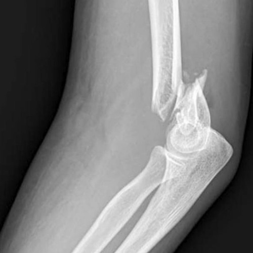 Stream episode Fracturas de Humero Distal by Damaris Hernández podcast ...