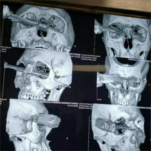 Stream SKELETON VISION by SKULLXLAIN | Listen online for free on SoundCloud