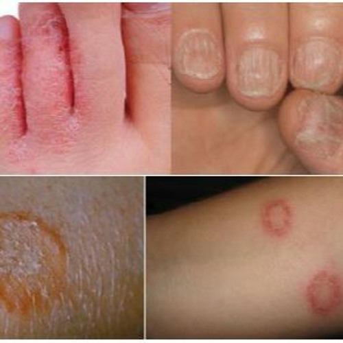 Infecciones Por Hongos En Humanos