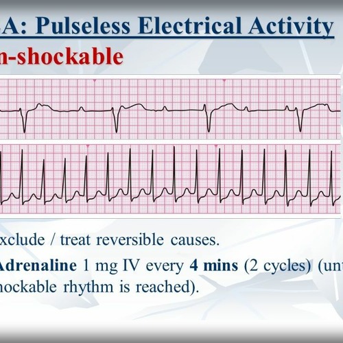 Pulseless Electrical Activity Ecg Strip