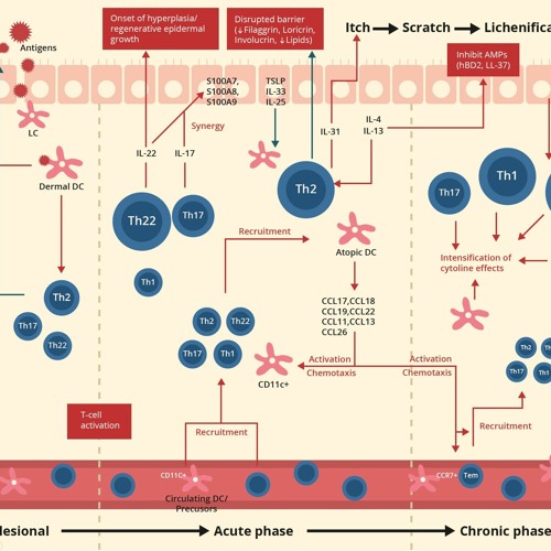Stream episode S07E01 Type 2 inflammation, atopic dermatitis by Jason K ...