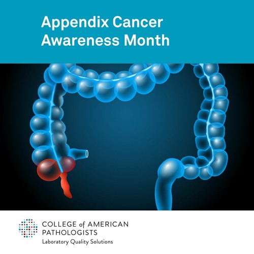 Stream episode Appendix Cancer Awareness Month by CAPcasts from the ...