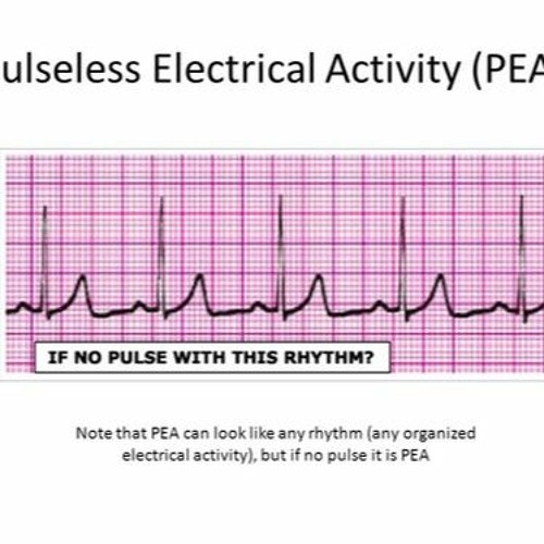 Stream Pulseless Electrical Activity Pdf Free Fixed by Yeudabuchtb ...