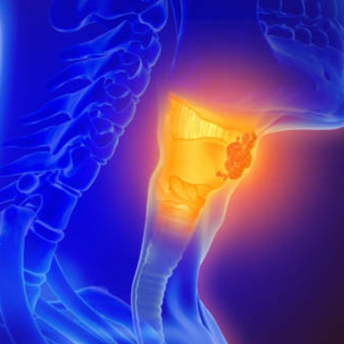 Stream Larynx Polyp Treatment | Remove the Polyp & Protect the Vocal ...