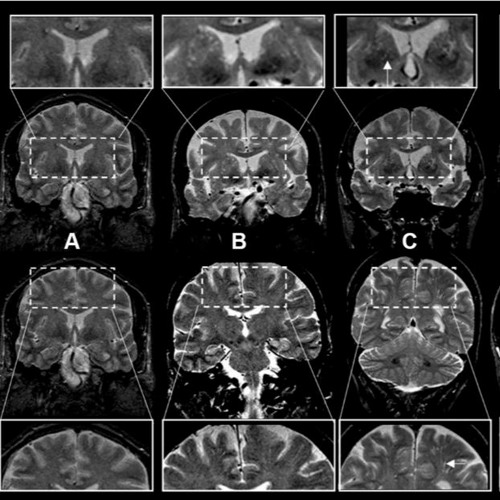 Stream episode Press Release: Aging, Prevalence and Risk Factors of MRI ...