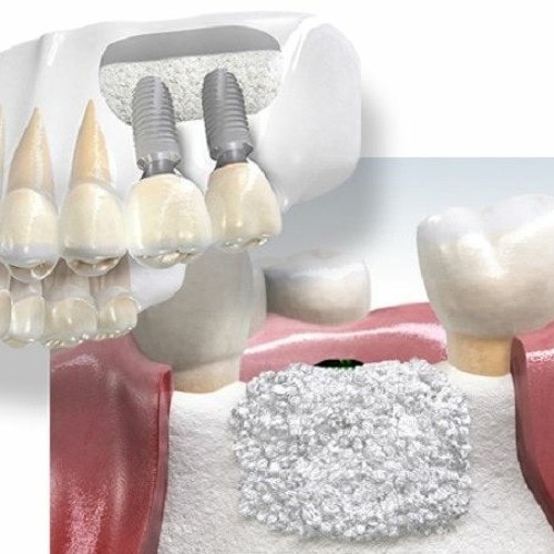 Stream Benefits Of Multi - Unit Abutments For Implant Retained ...