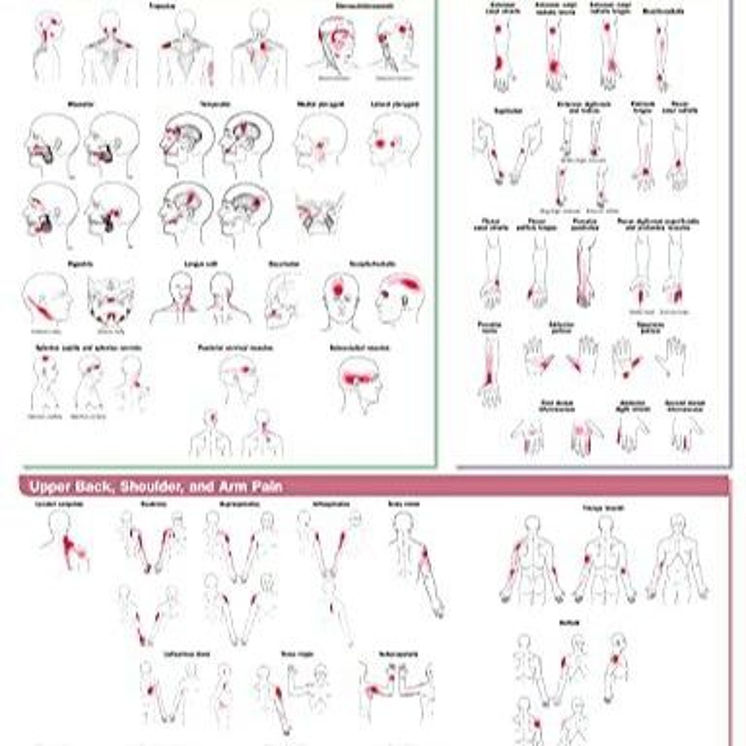 Stream episode Epub Travell, Simons & Simons? Trigger Point Pain ...