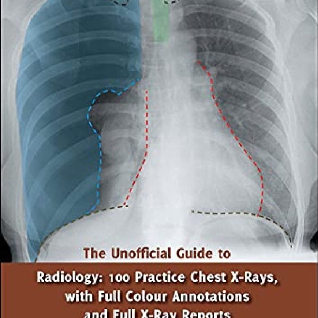 Stream (*PDF/KINDLE)->DOWNLOAD The Unofficial Guide to Radiology: 100 Practice Chest X Rays with ...