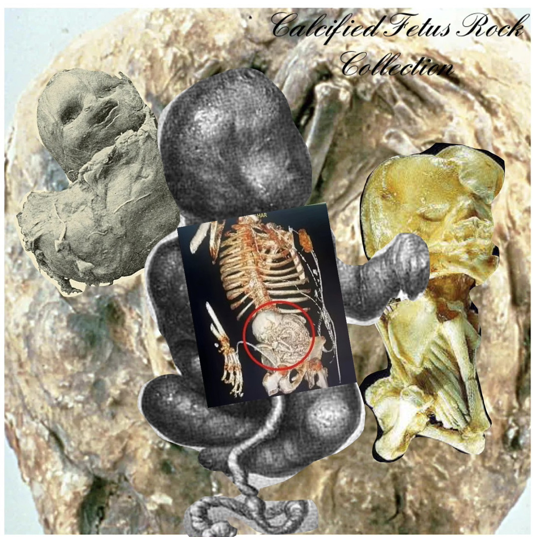 Stream A flask made from the petrified remains of an anencephalic fetus ...