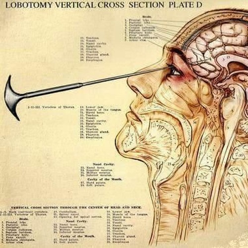 Lobotomia Lobotomy | Definition, Procedure, History, Effects, & Facts
